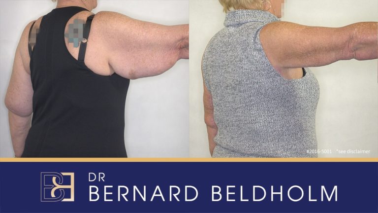 Top Tips for Brachioplasty Recovery: Guide to a Smooth Healing Process